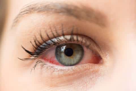 6 Common Causes of Eye Infection | Jackson Davenport